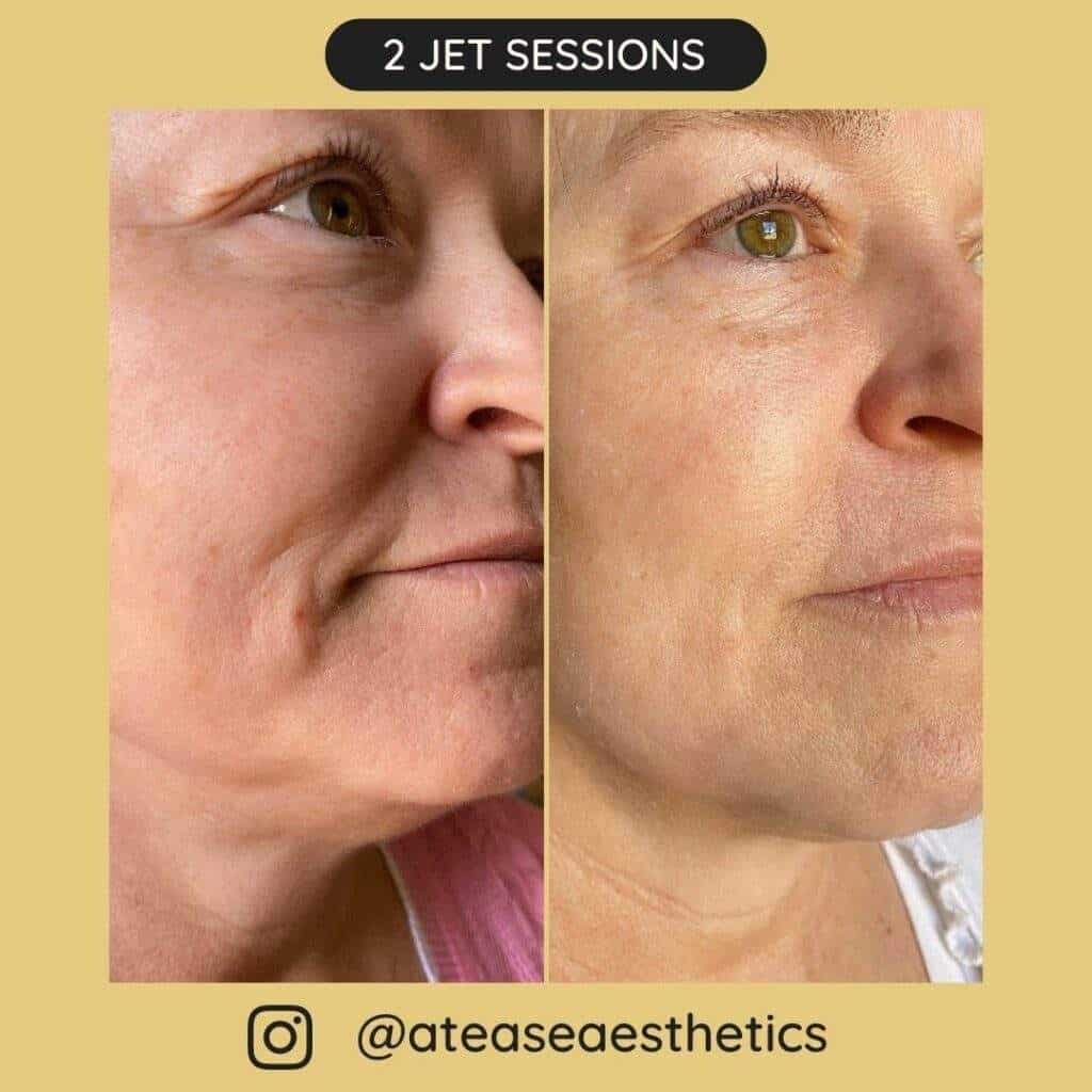 Revolutionizing Skincare with Profosma Jet Plasma: A Lazer Lux ...